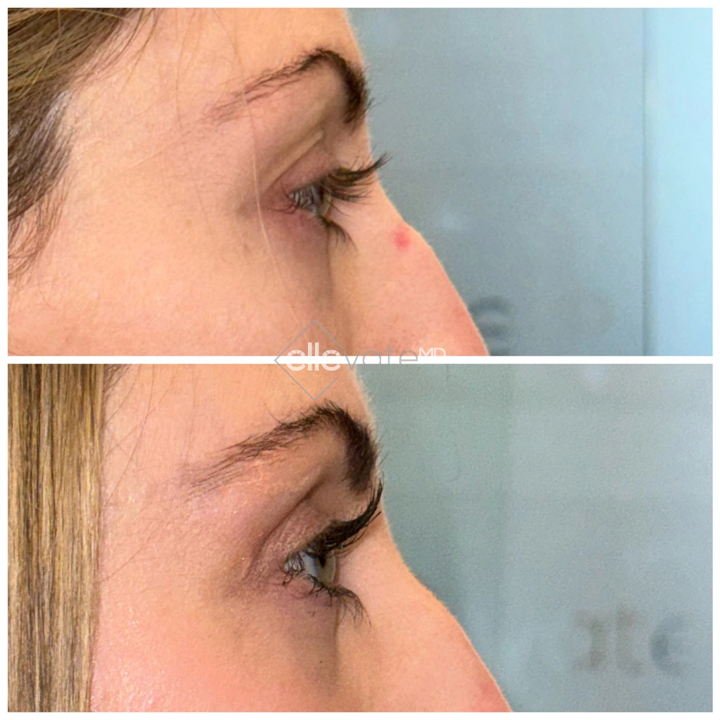 Upper Lid Lift Profile View 62 | Before & After Result Photos