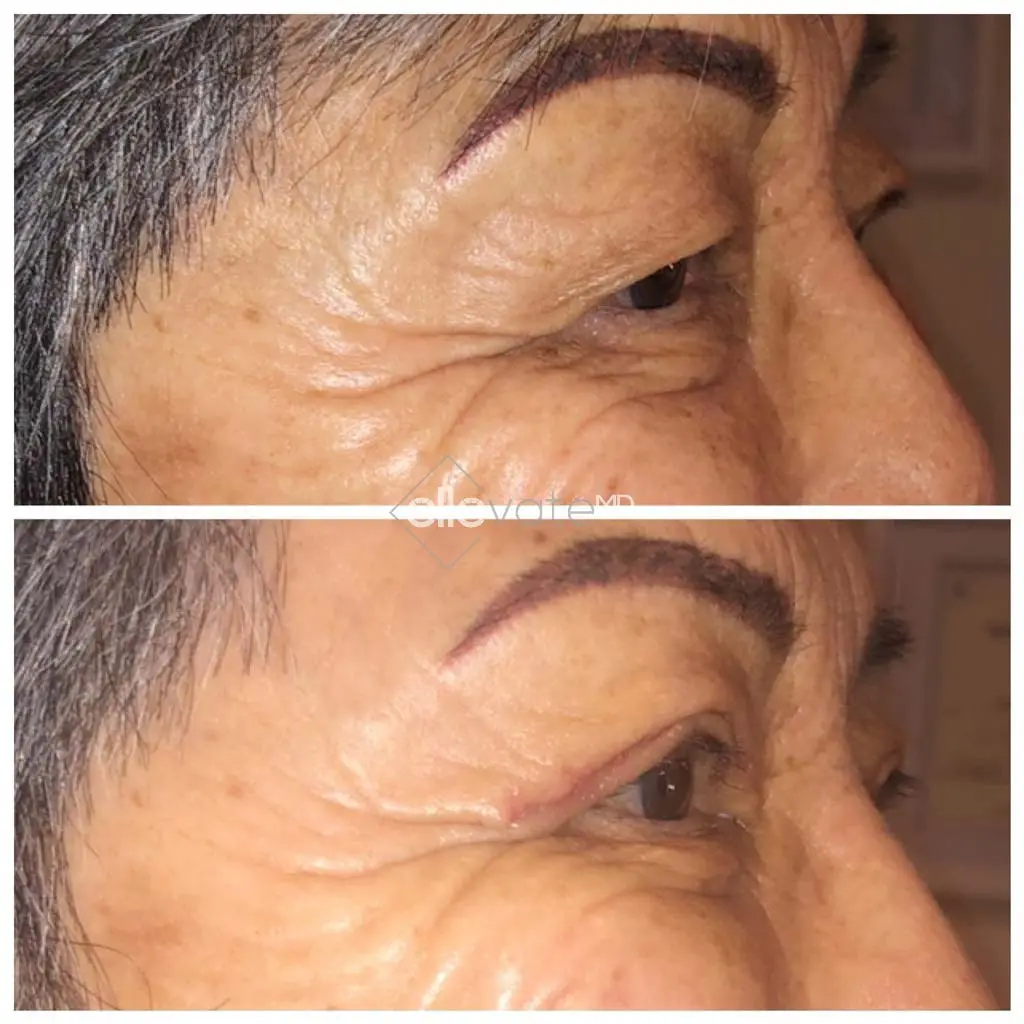 Upper Lid Lift Profile View 50 | Before & After Result Photos