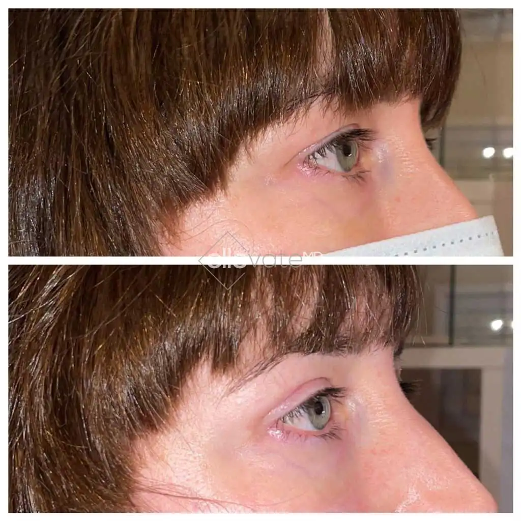 Upper Lid Lift Profile View 57 | Before & After Result Photos