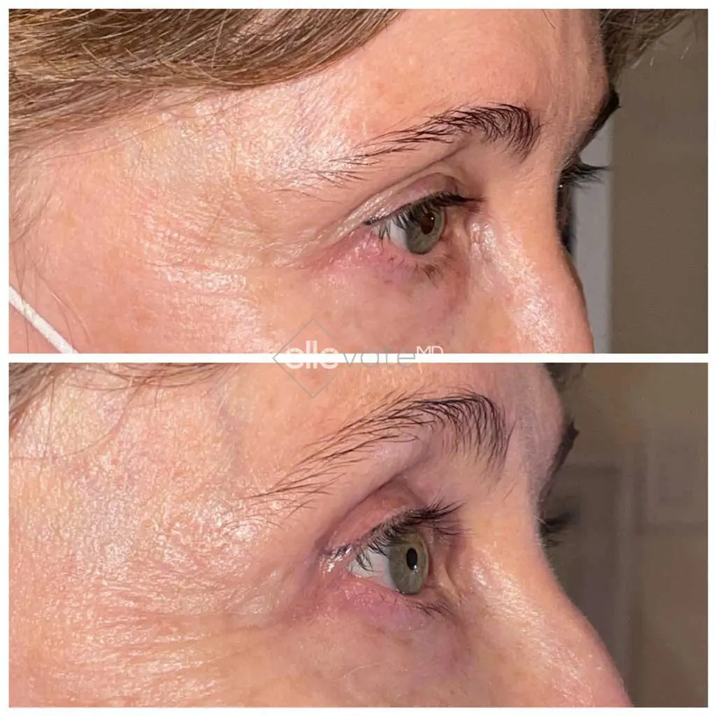 Upper Lid Lift Profile View 56 | Before & After Result Photos