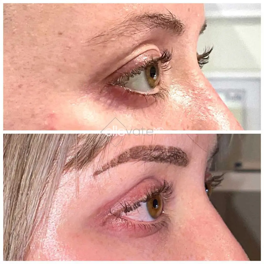 Upper Lid Lift Profile View 54 | Before & After Result Photos